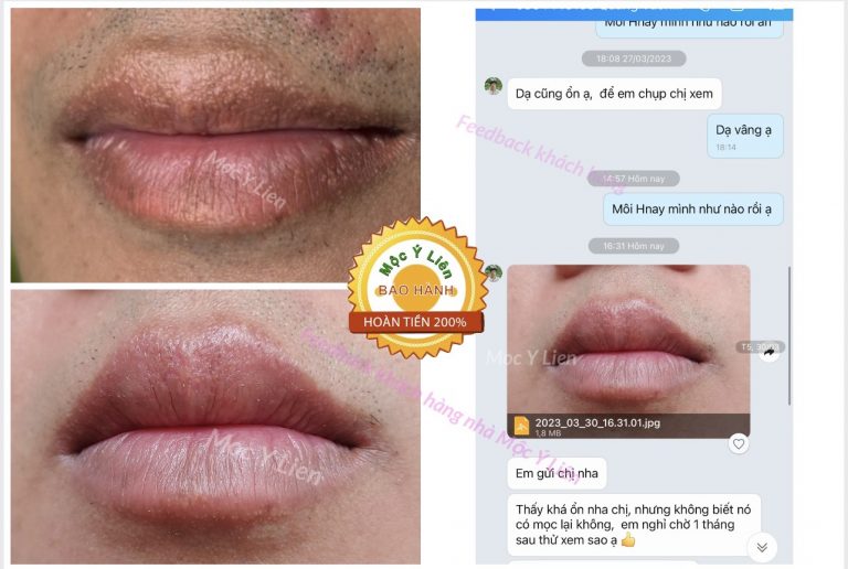 Môi bị hạt trắng li ti do đâu? Cách phương pháp điều trị môi bị hạt ...