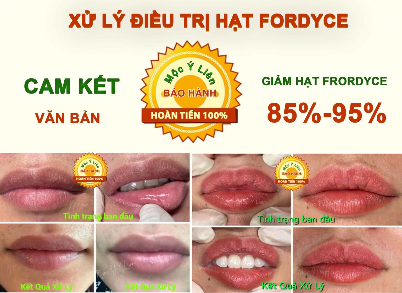 Hạt Fordyce trên môi Có Tự Khỏi Không