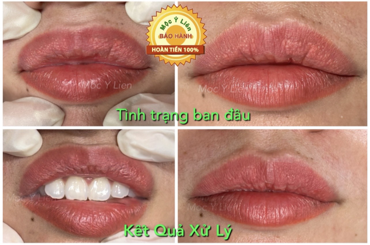 Môi bị hạt trắng li ti do đâu? Cách phương pháp điều trị môi bị hạt ...