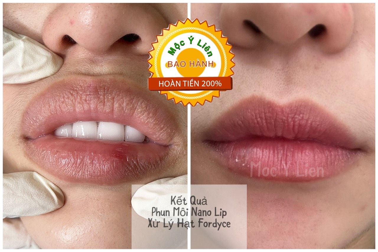 Môi bị hạt trắng li ti do đâu? Cách phương pháp điều trị môi bị hạt ...