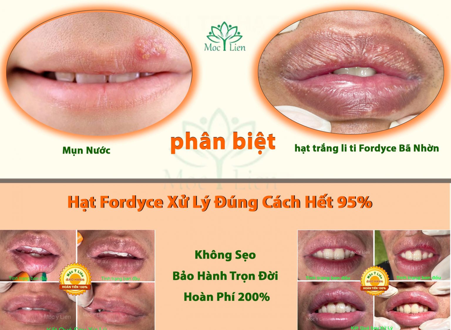 Hạt Fordyce ở môi và cách điều trị