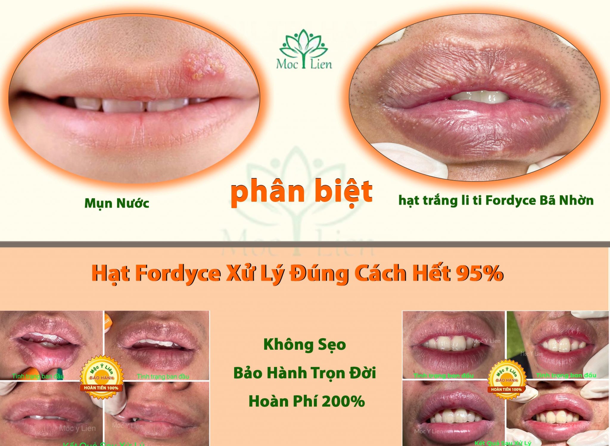 Hạt Fordyce ở môi và cách điều trị