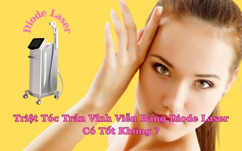 Có Nên Triệt Tóc Trán Vĩnh Viễn Bằng Laser